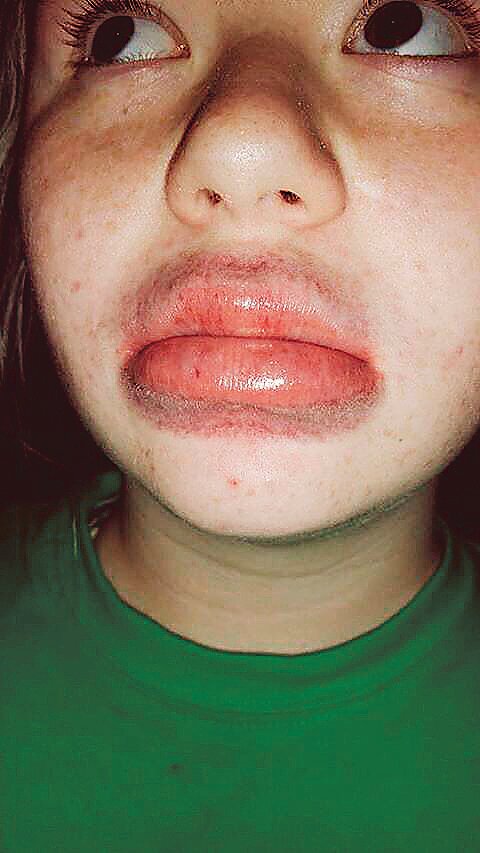 Lip challenge first goes awry, then goes viral - Storm Lake Times Pilot